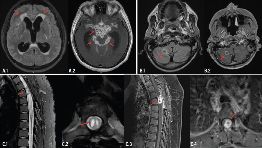 Neurologic Complications of Globally Prevalent Infectious Di