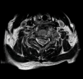 Spinal Cord Infarct: Clinical & Imaging Pearls