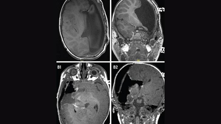 Epilepsy Essentials: Hemispherectomy for Early-Onset Pediatr