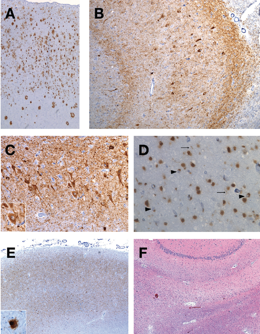 A Precision Medicine Approach to Dementia Care: Syndrome, Et