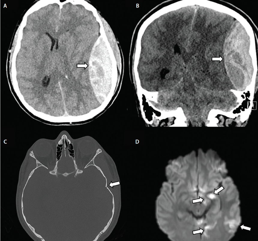 Neuroimaging Traumatic Brain Injuries