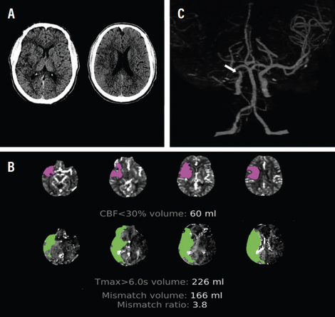 Stroke Snapshot: Endovascular Thrombectomy for Stroke Treatm