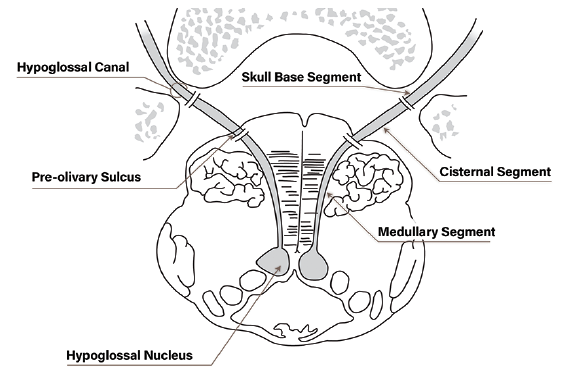 Persistent Idiopathic Isolated Hypoglossal Nerve Palsy