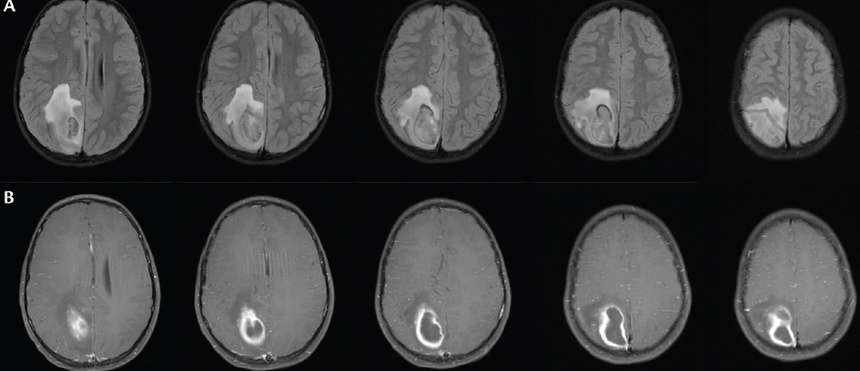 Focal Status Epilepticus 9 Years After Brain Abscess