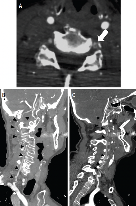 Bilateral Vertebral Artery Dissection and Occlusion After a
