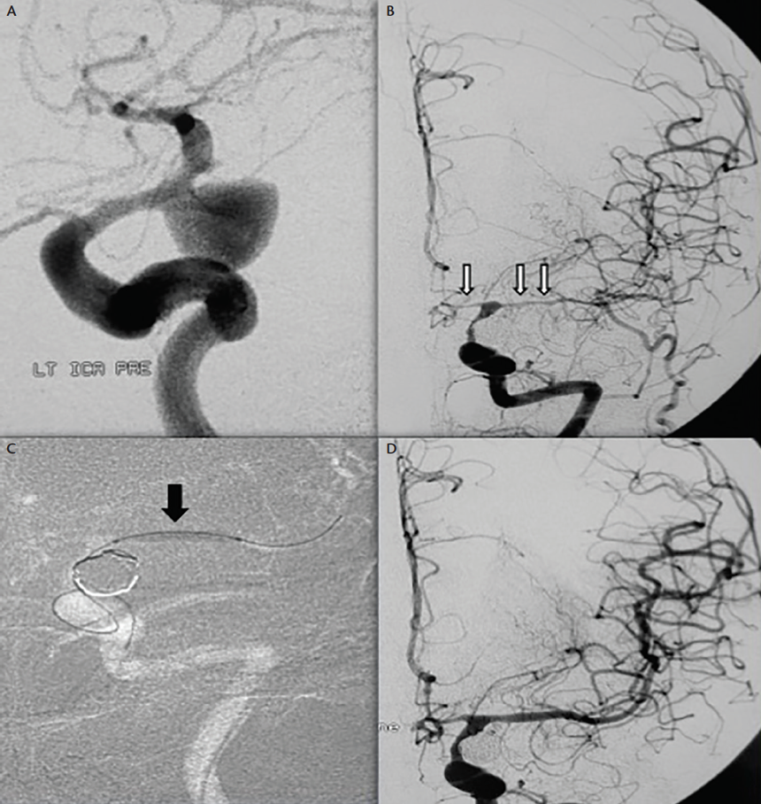 Subarachnoid Hemorrhage, Vasospasm, and Delayed Cerebral Isc