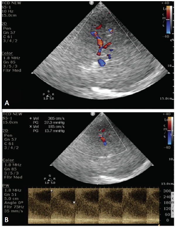 Subarachnoid Hemorrhage, Vasospasm, and Delayed Cerebral Isc