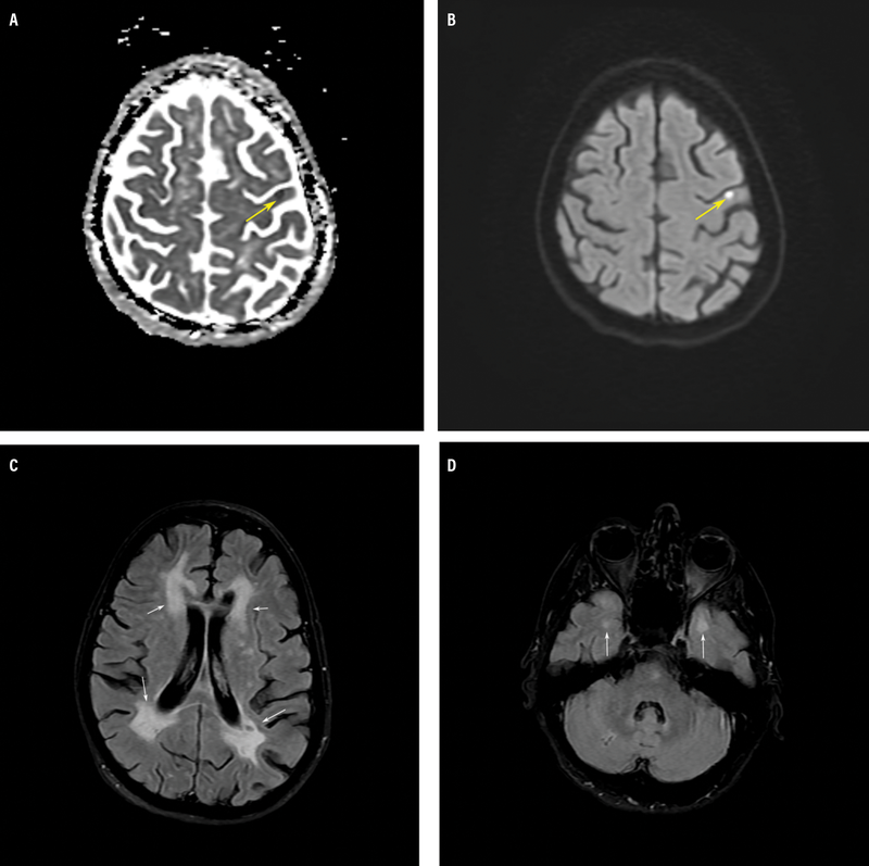 CADASIL Misdiagnosed as Multiple Sclerosis - PracticalNeurology