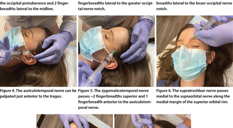 Bilateral Temporalis Muscle Hypertrophy with Headache, Pain