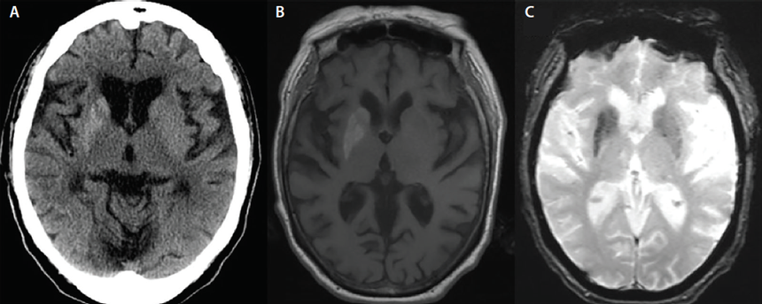 Case Report: Hemichorea in a Woman With Diabetes