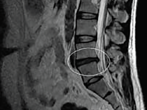 Spinal Pain: Acute & Chronic Management