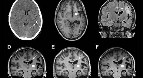 Child Neurology