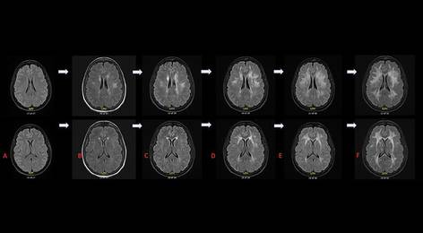 Epilepsy Essentials: Hemispherectomy for Early-Onset Pediatr