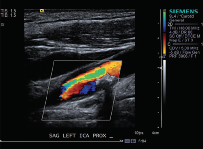 Asymptomatic Carotid Artery Stenosis