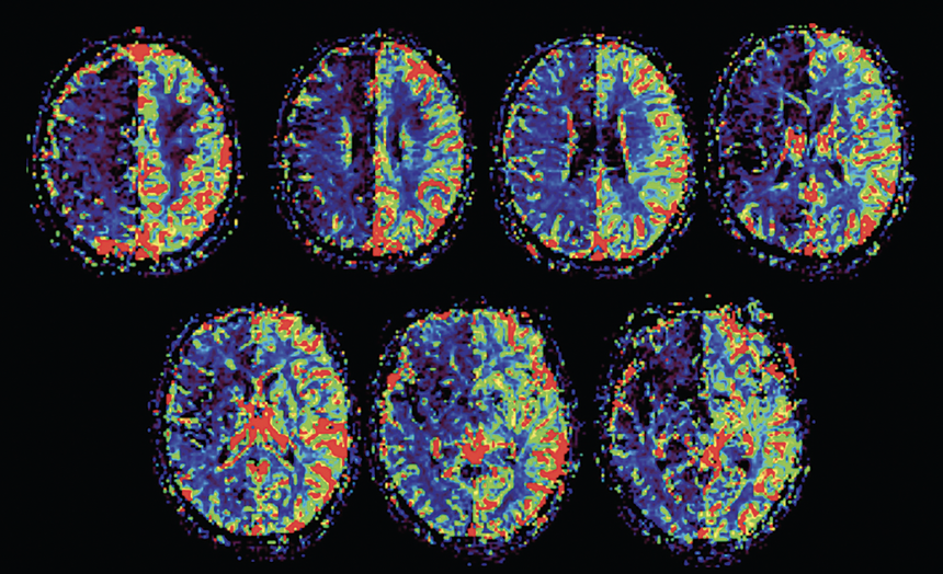 Corpus Callosum Infarct
