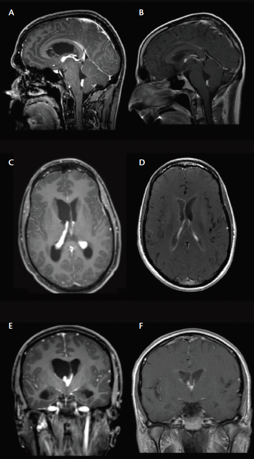 Severe Inflammatory Response Causing Choroid Plexitis and Ac