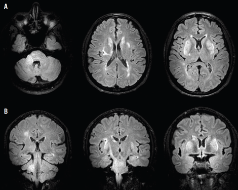 Acute Encephalopathy With Unusual Brain Lesions