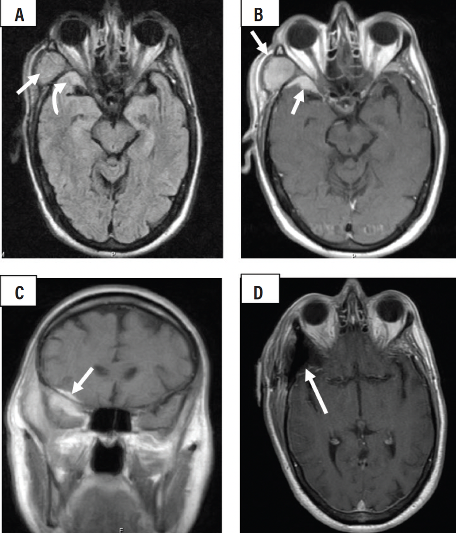 Sphenoid Wing Meningioma Presenting With a Temporal Fossa Ma