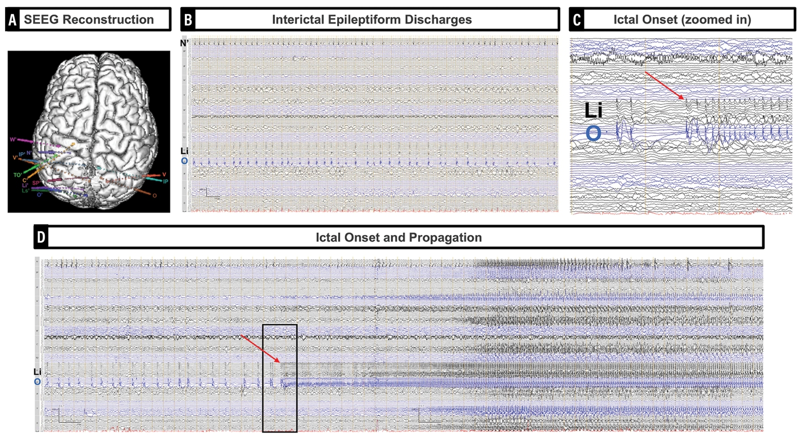Utility of SEEG in the Treatment of Drug-Resistant Epilepsy