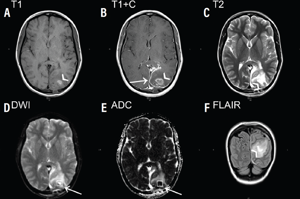 Intracranial Infections: Bacterial, Viral, Fungal, Parasitic