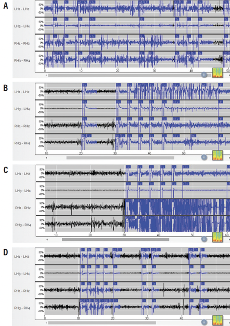 Return of Auras Following Treatment of Focal-Onset Seizures