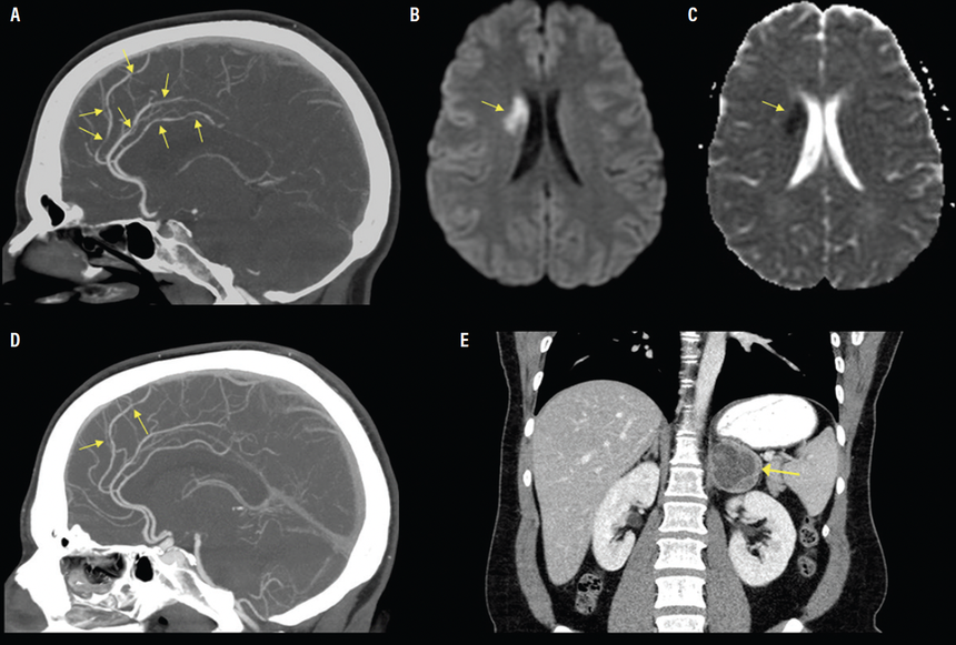 Cerebral Vasoconstriction and Vasospastic Angina Secondary t