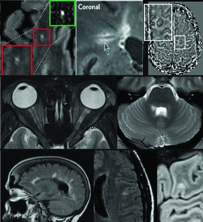 Updates to the McDonald Diagnostic Criteria for MS