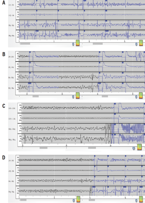 Return of Auras Following Treatment of Focal-Onset Seizures