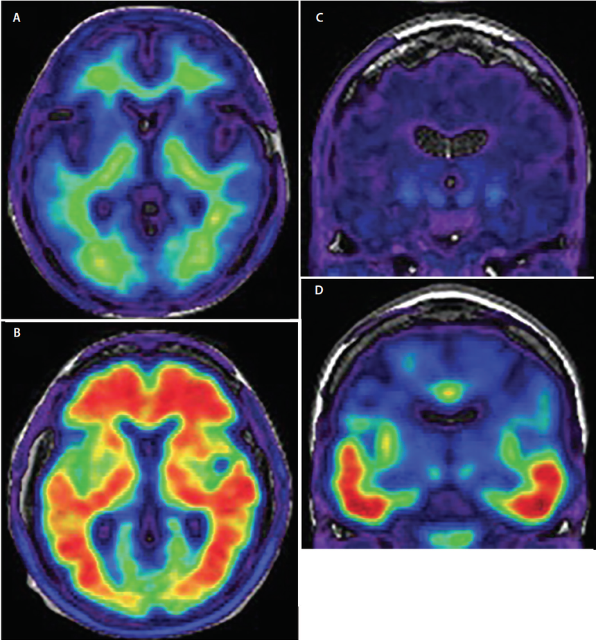 Brain Imaging in Differential Diagnosis of Dementia