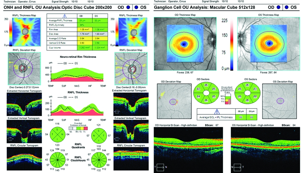 Paraclinical Optic Nerve Tests in Multiple Sclerosis