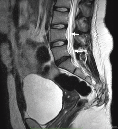 Tuberculous Radiculomyelitis