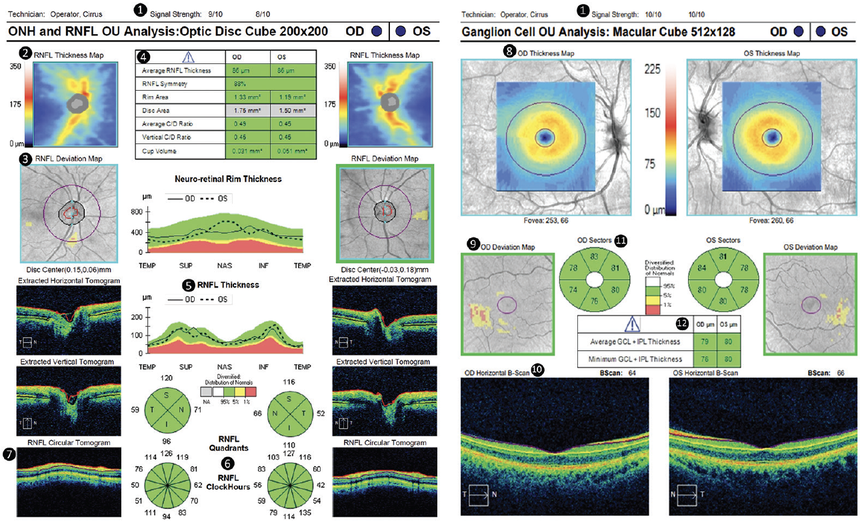 MS Minute: Retinal Optical Coherence Tomography for MS