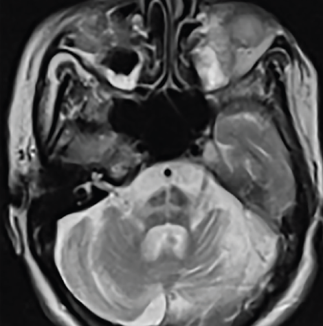 Atypical Parkinsonian Syndromes