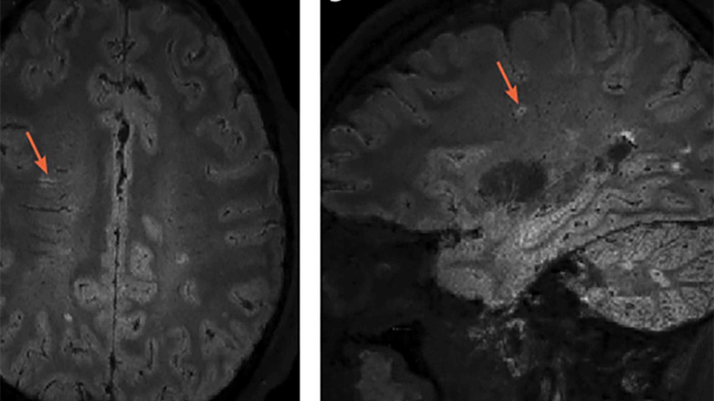 Multiple Sclerosis Minute: The Central Vein Sign in Diagnosi