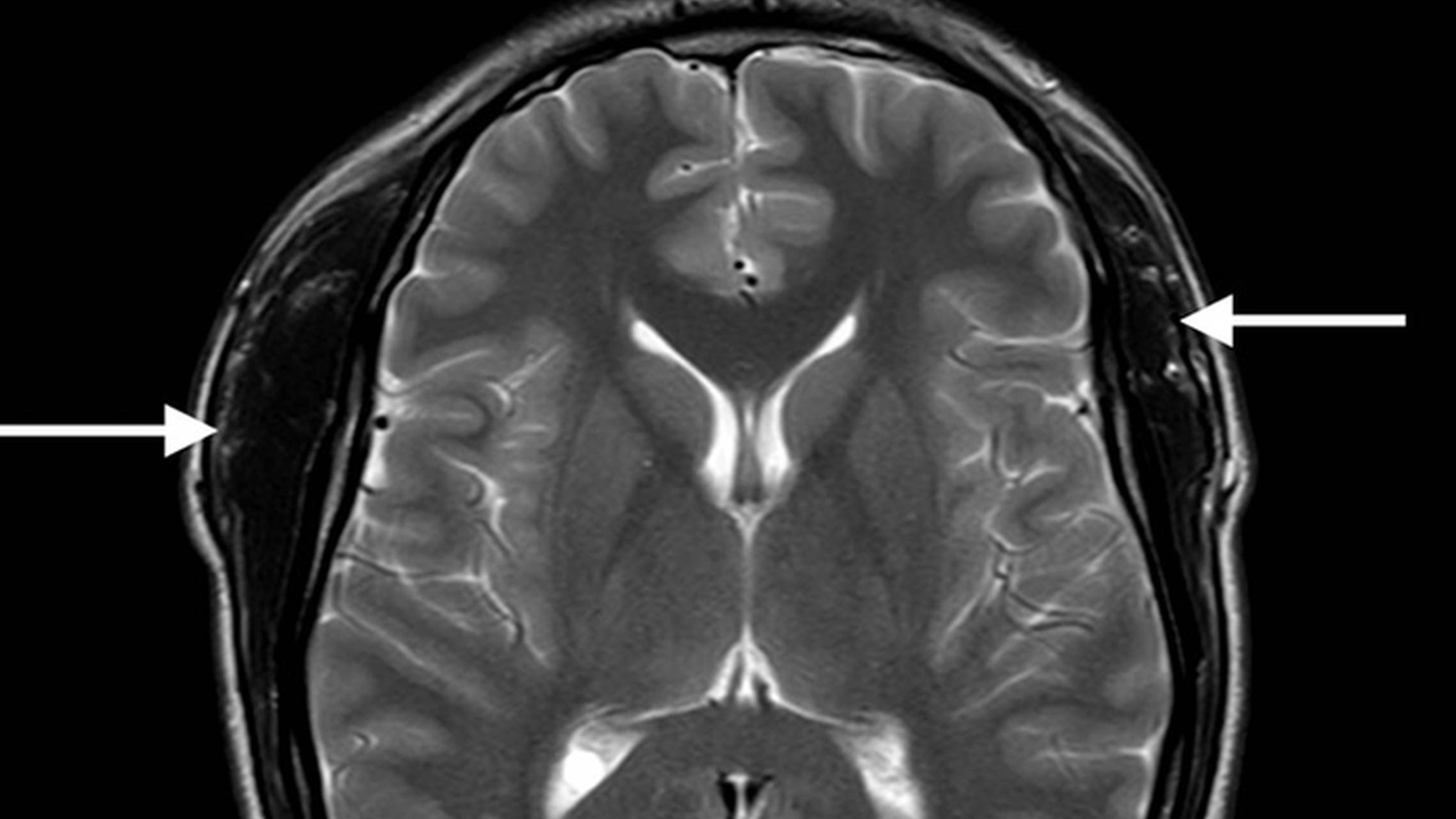 Bilateral Temporalis Muscle Hypertrophy with Headache, Pain