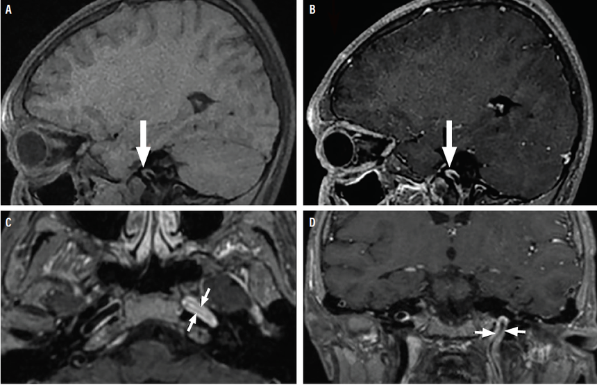 Stroke Snapshot: Intracranial MRI Vessel-Wall Imaging