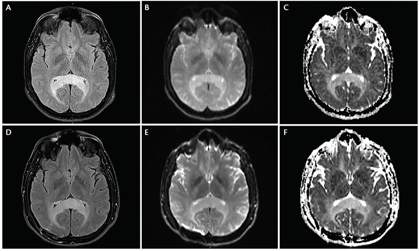 Reversible and Benign Lesions of Splenium of The Corpus Coll