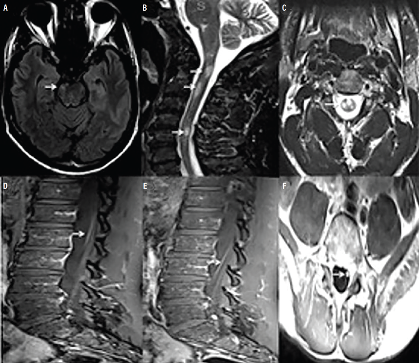 MOG Antibody Disease