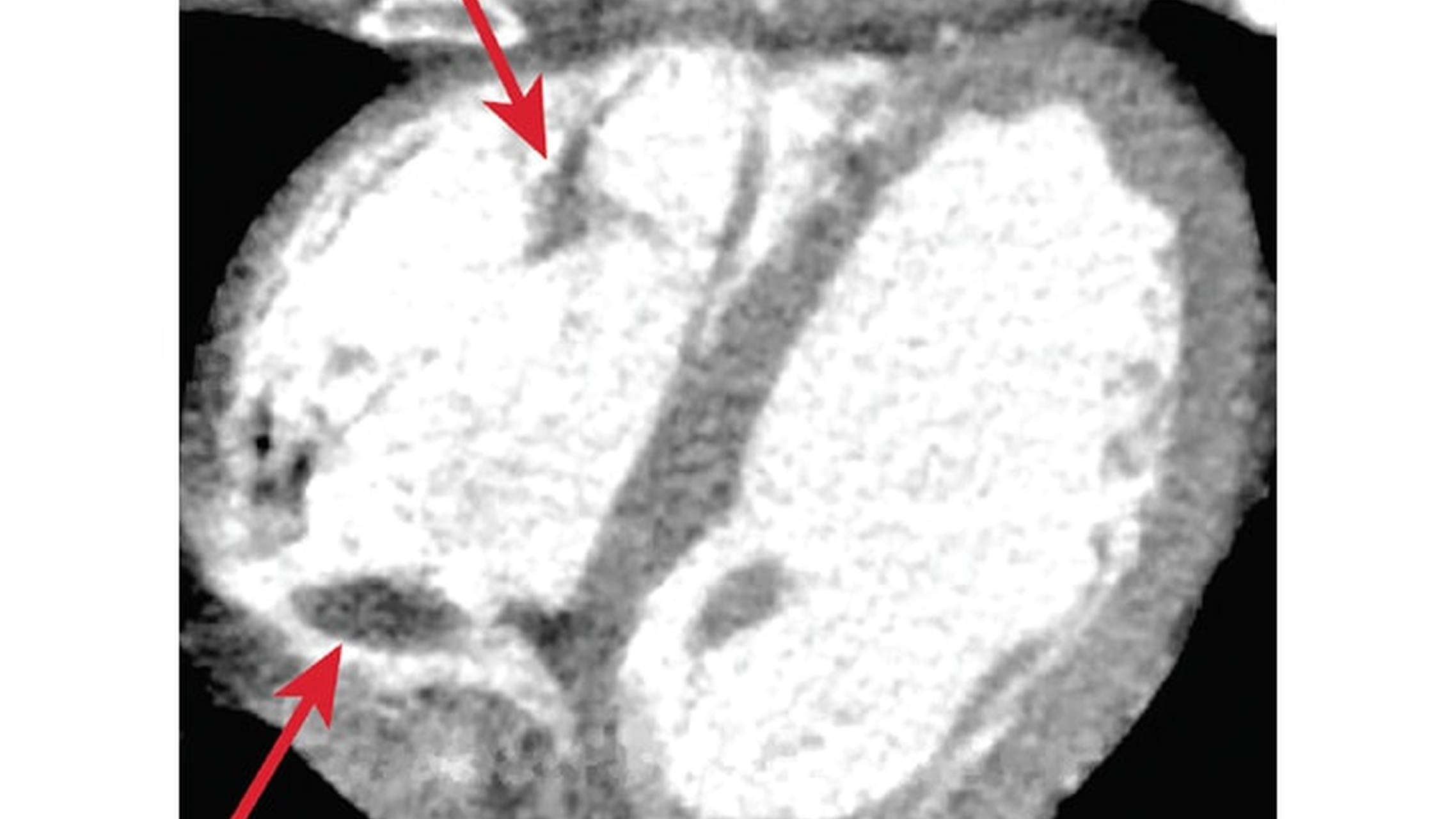 Stroke Spotlight: Hypercoagulable States in Ischemic Stroke