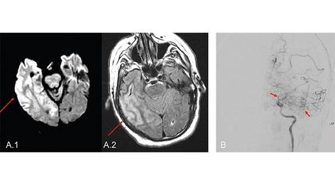 Reversible and Benign Lesions of Splenium of The Corpus Coll