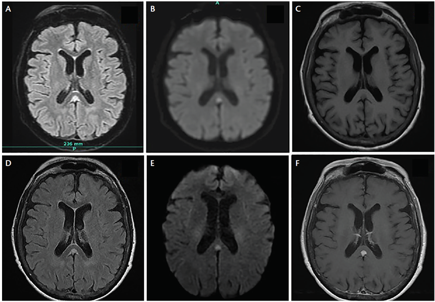 Reversible and Benign Lesions of Splenium of The Corpus Coll