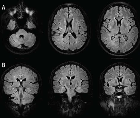 Acute Encephalopathy With Unusual Brain Lesions