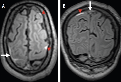Cerebral Venous Thrombosis Presenting as Recurrent Transient