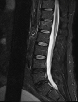Spinal Cord Infarct: Clinical & Imaging Pearls