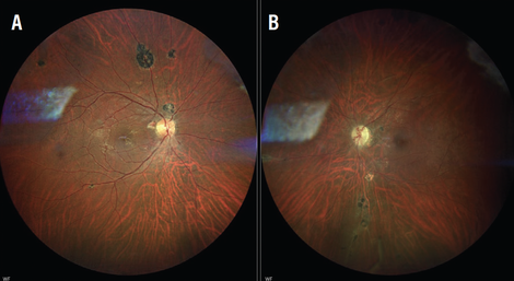 Cytomegalovirus and Herpes Simplex Virus Coinfection Neurore