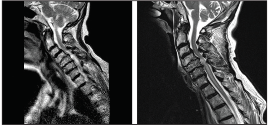 Spinal Cord Infarct: Clinical & Imaging Pearls