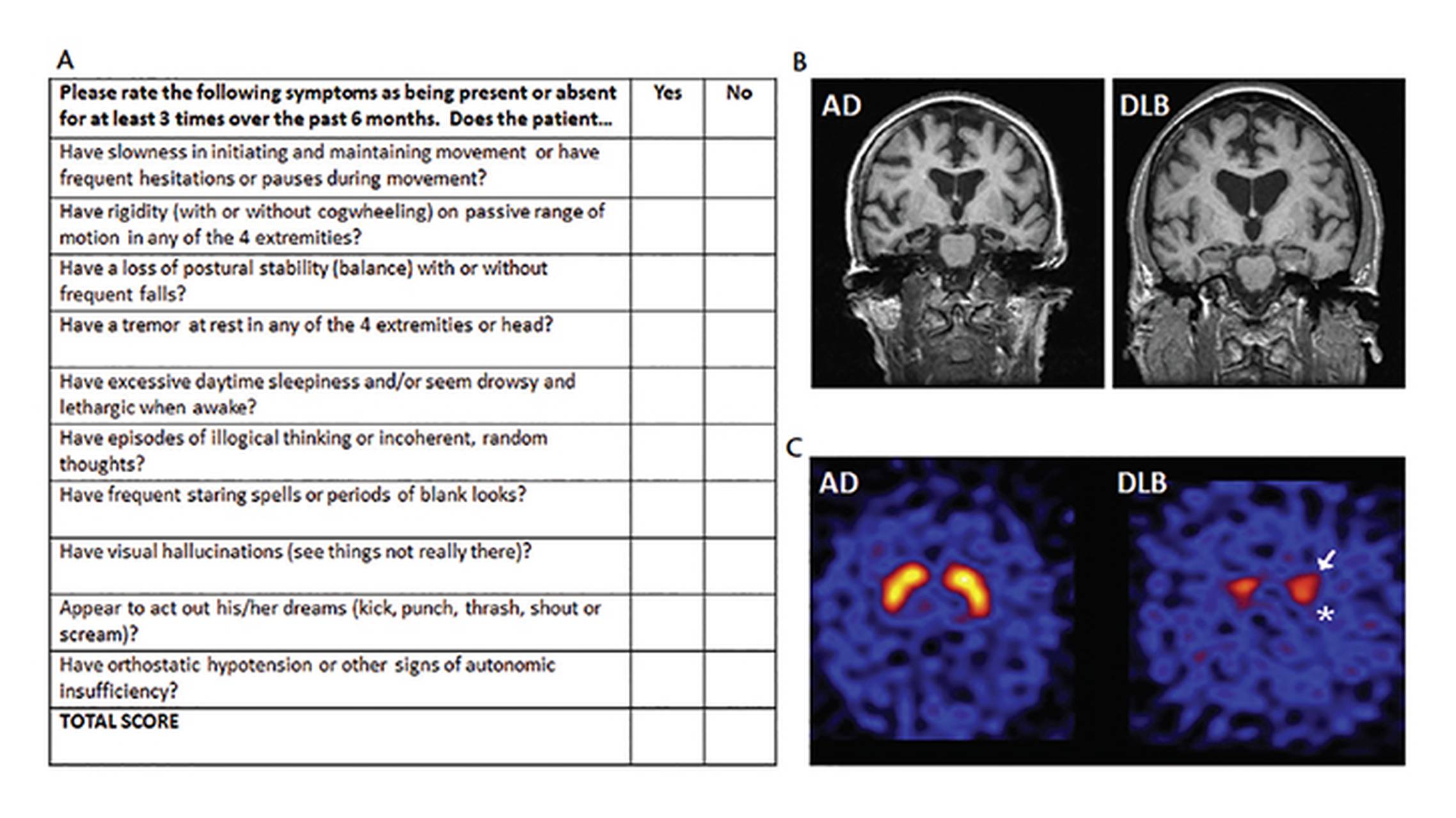 Lewy Body Dementia