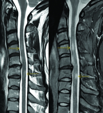 Radiologic Biomarkers in Multiple Sclerosis