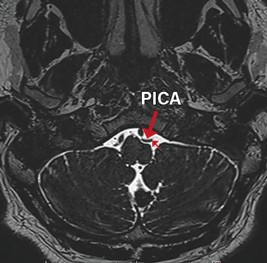 Persistent Idiopathic Isolated Hypoglossal Nerve Palsy
