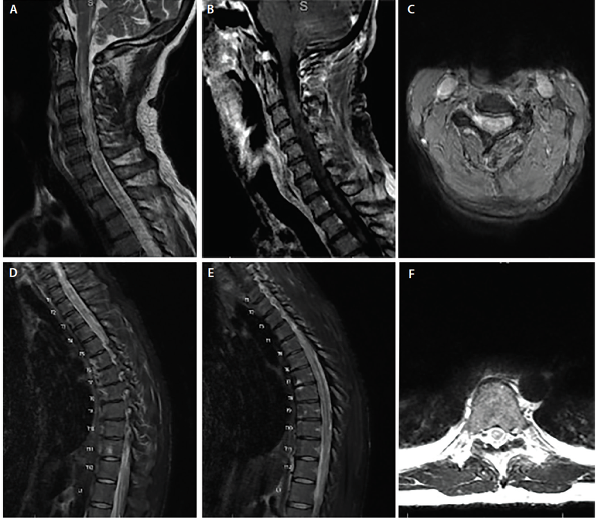 Case Report: Neuromyelitis Optica Associated With SARS-CoV-2